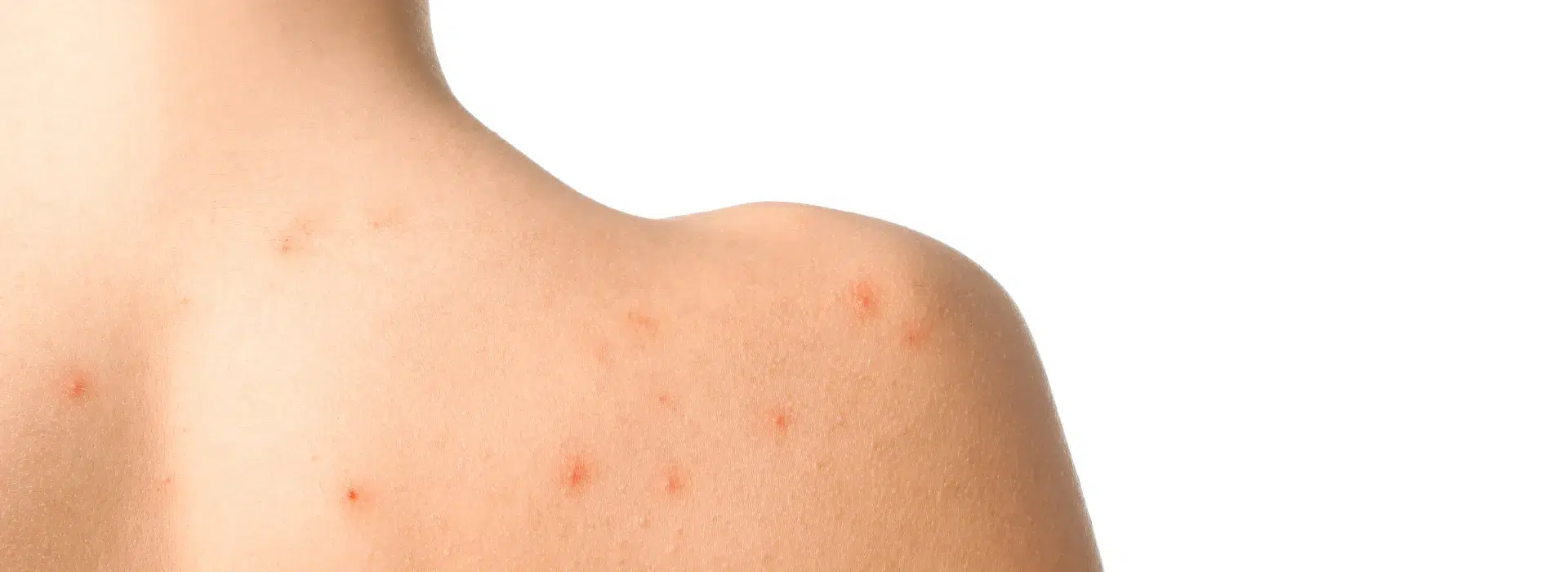 How to get rid of back acne? Doctor-approved remedies