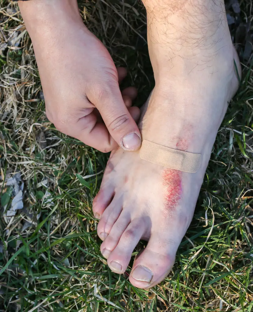 Blisters Treatment - Hola Health