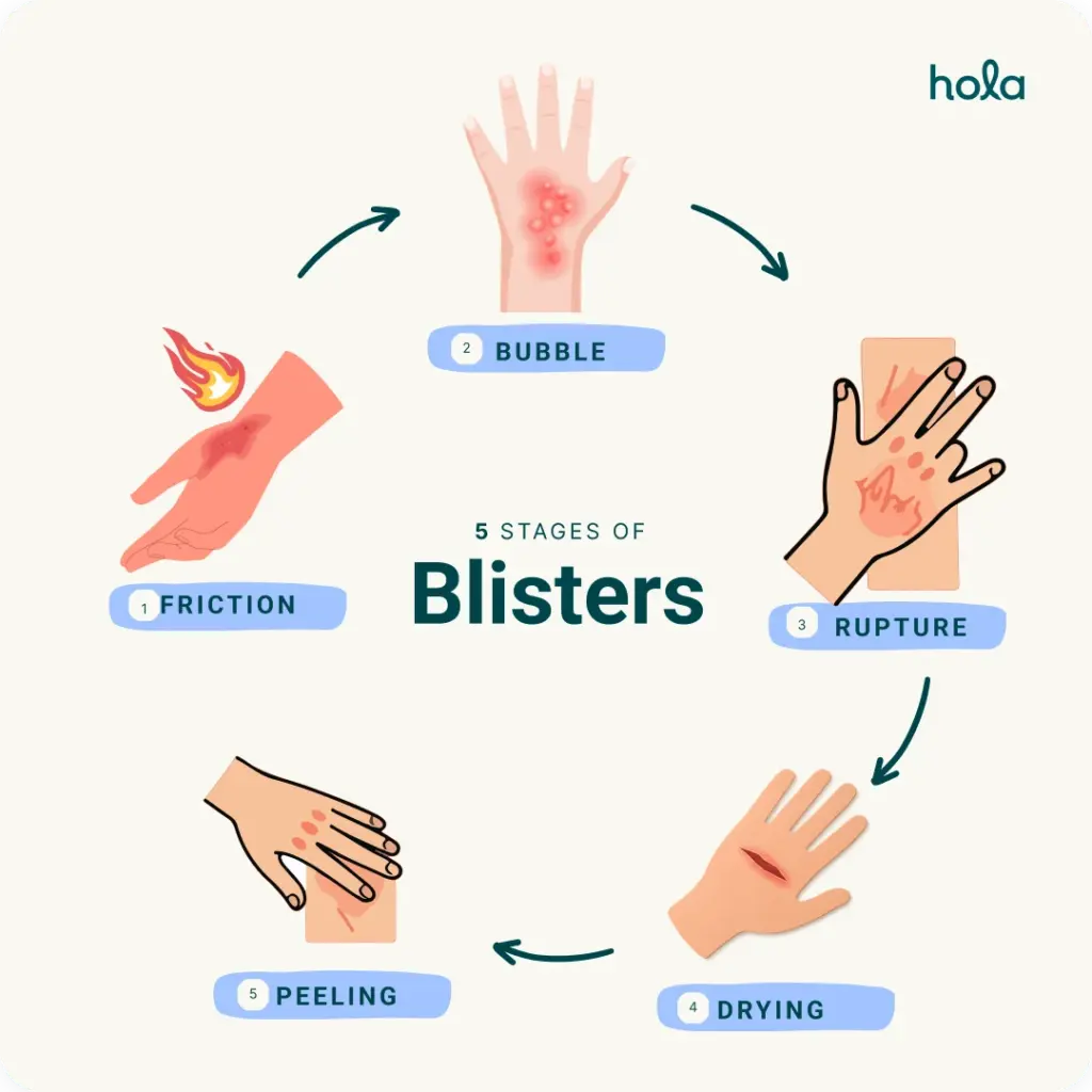 Blisters Treatment - Hola Health