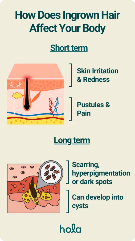 Ingrown Hair Online Doctor Consult